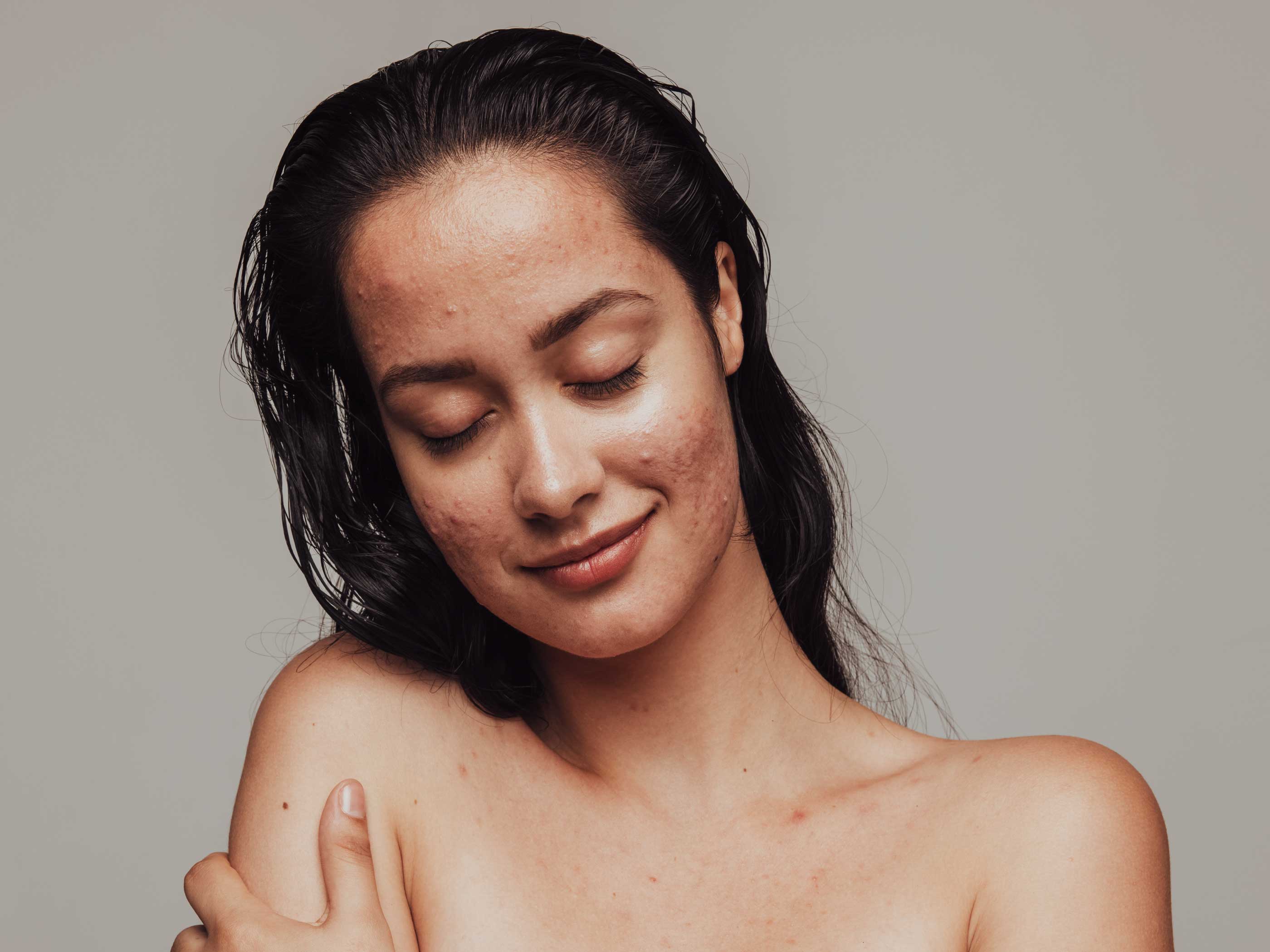 Understanding the Different Types of Skin Congestion – esmi Skin Minerals