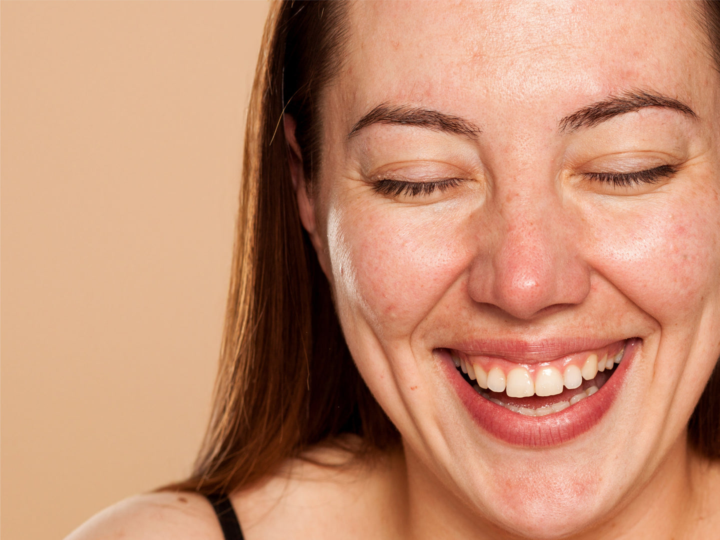 Isotretinoin & Roaccutane Skincare Routine | esmi Skin Minerals