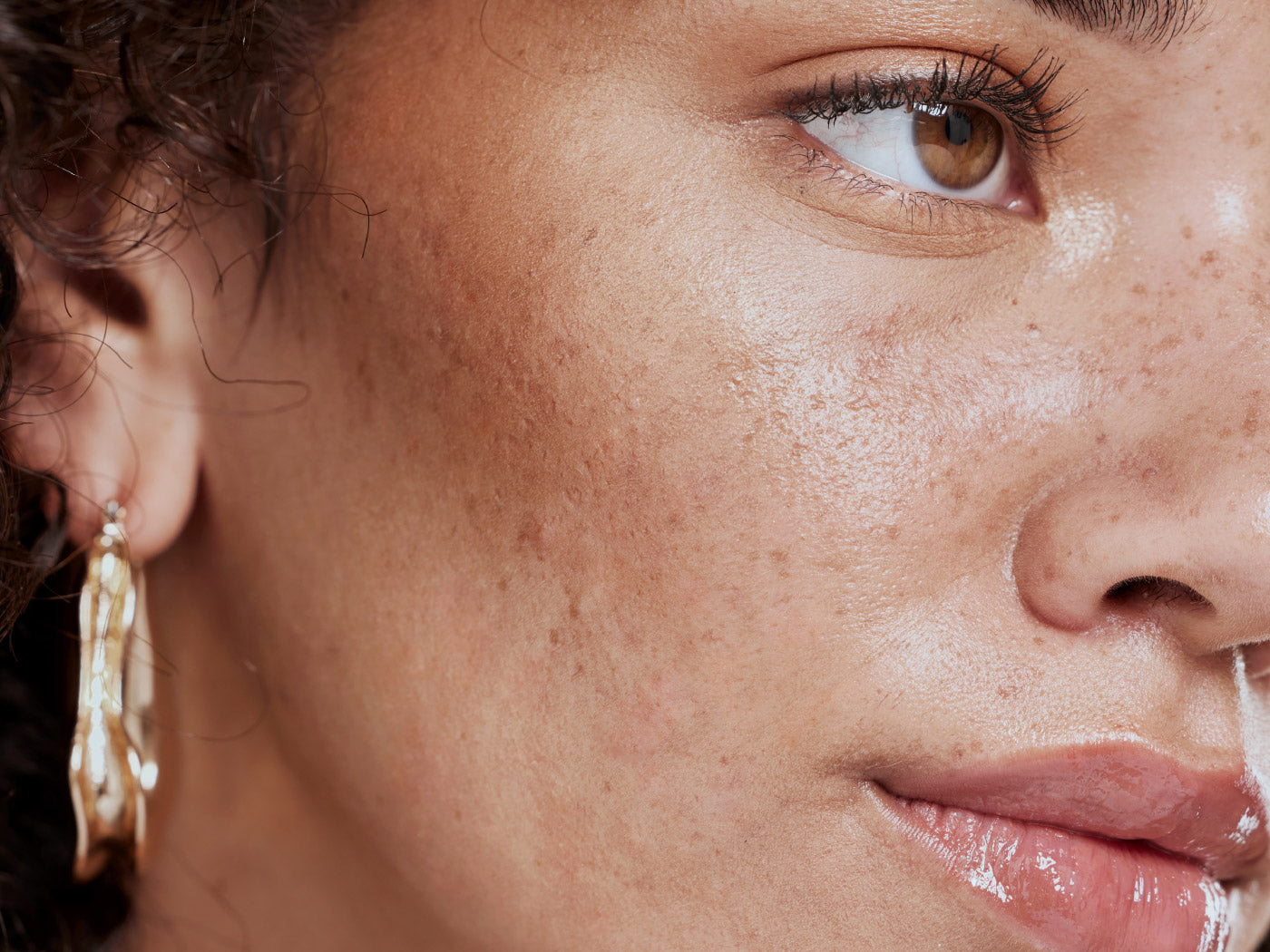 Understanding Different Types of Scarring and Targeted Solutions – esmi ...